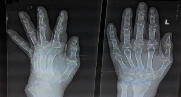 Hand Rehabilitation after Sudeck's Atrophy | REHAB GLOVES