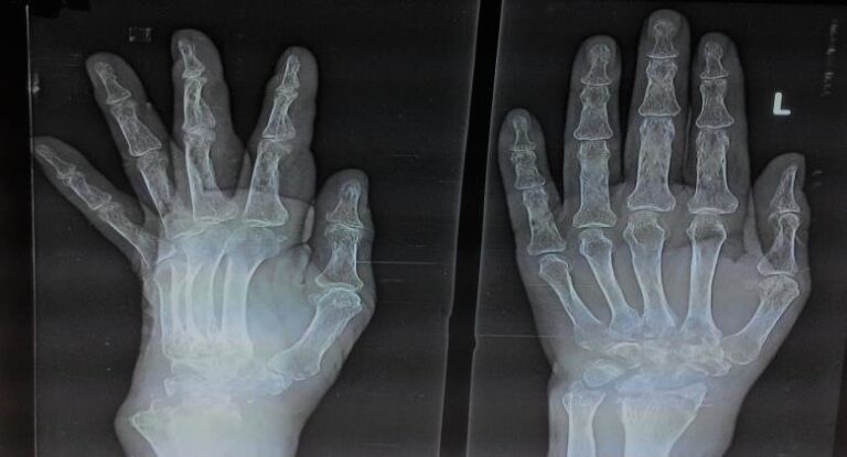 Hand Rehabilitation after Sudeck's Atrophy | REHAB GLOVES